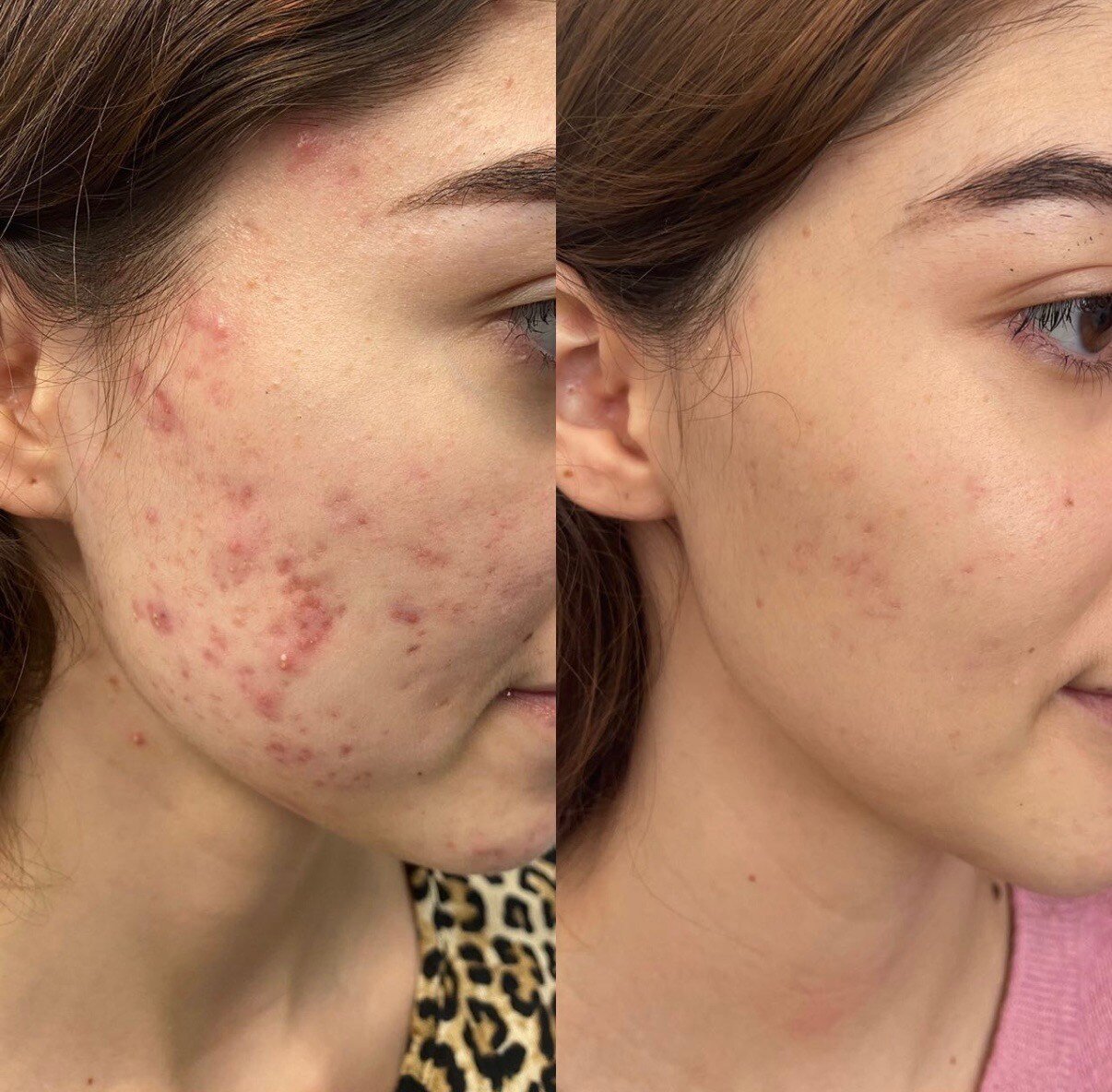 Microneedling Newport Beach | Revitalize Your Skin | Skinsation OC